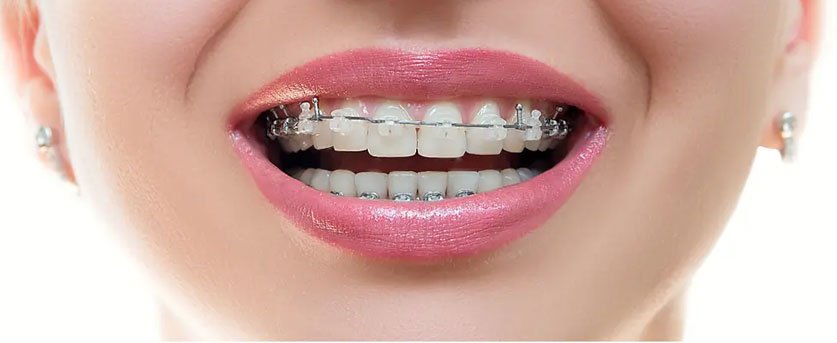 Ceramic braces: What Are The Main Benefits? - Transits Blog