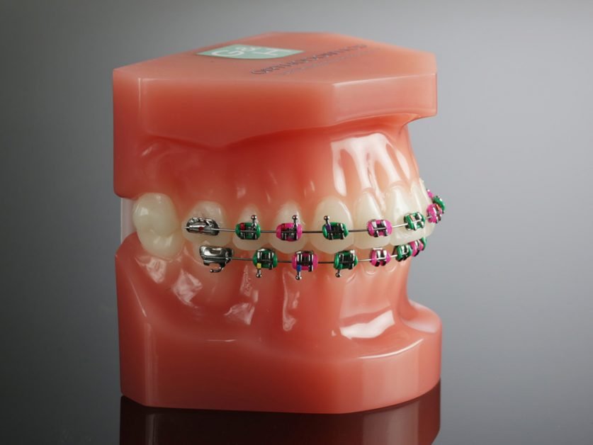 What Are The Best Different Color Braces Options Available For Girls ...