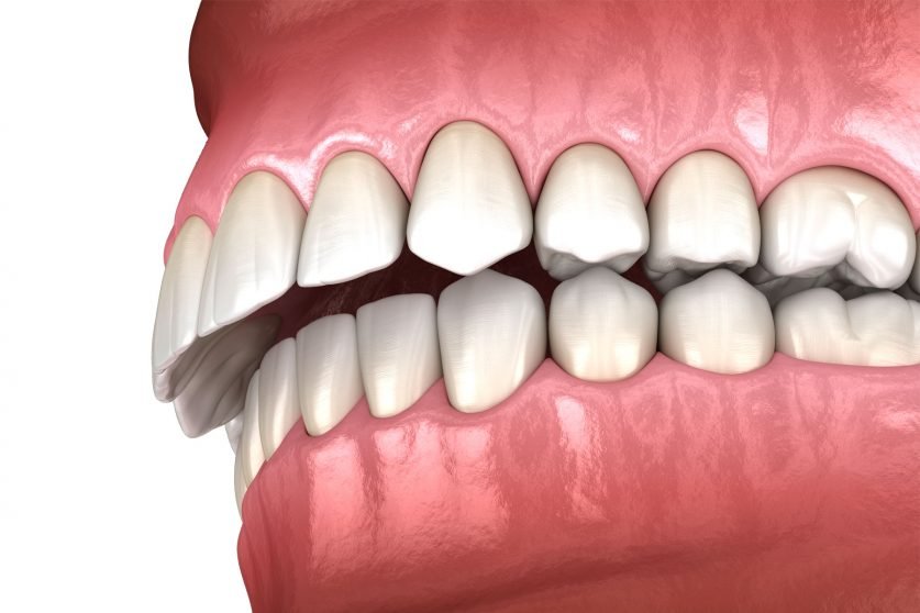Overbite Braces | Overbite Before And After