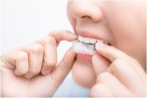 Invisalign Rubber Bands | Enhancing Orthodontic Treatment